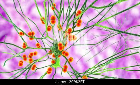 Bacterial brain infection. Conceptual computer illustration showing ...