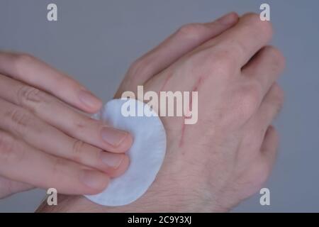 Man trying to treat cat scratches with cotton pad and hydrogen peroxide ...