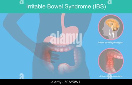 Illustration about abnormal symptom of human large Intestine Stock ...