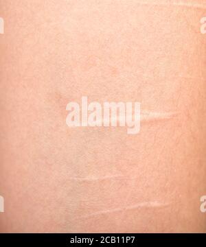 Woman showing her scar after a surgery. C section, fibroids operation ...