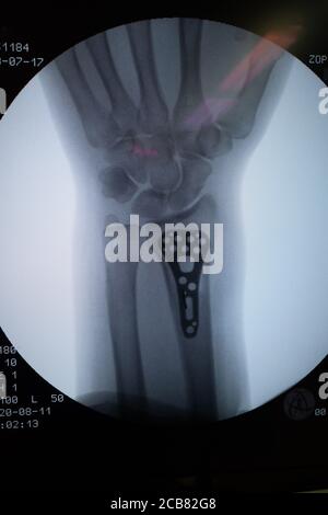 X-ray forearm with arthritis at wrist and elbow (Rheumatoid,Gout Stock ...