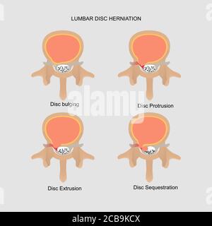 Herniated spinal disc - Degenerative, Protrusion, Extrusion ...