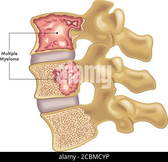 MULTIPLE MYELOMA, BONE MARROW Stock Photo - Alamy