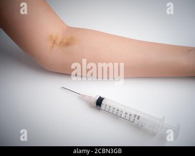 Bruise on arm from the injection Stock Photo - Alamy