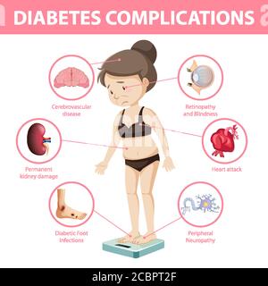 Diabetes complications information infographic illustration Stock ...