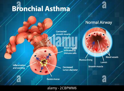 Asthma diagram with normal airway and asthmatic airway illustration ...