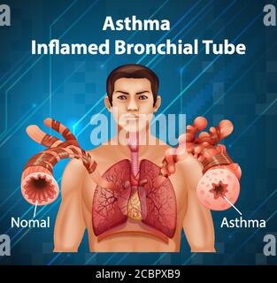 Bronchial Asthma diagram with normal lung and asthmatic lung ...