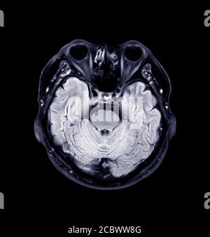 MRI of the brain Axial T1 view for detect a variety of conditions of ...