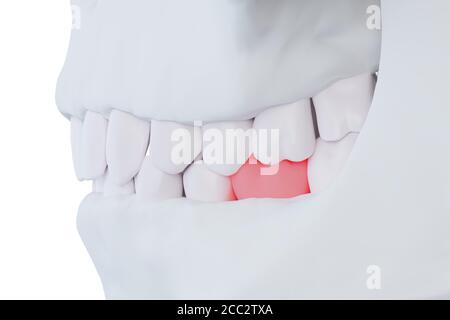 human teeth with a sore tooth, red lower sixth and upper fourth molar ...