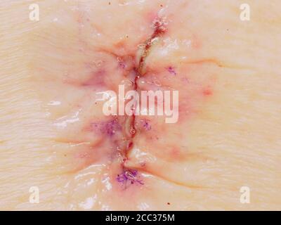 Lumbar Laminenectomy Surgery Incision Covered with Derma-Bond Glue ...