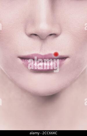 Cold sore or fever blister on the lip caused by Herpes infection Stock ...