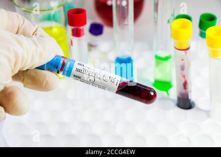 Tuberculosis blood test tube, laboratory and chemical instruments ...