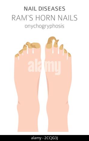 Nail diseases. Onychogryphosis, Ram`s horn nail. Medical infographic ...