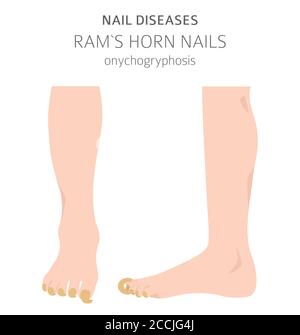 Nail diseases. Onychogryphosis, Ram`s horn nail. Medical infographic ...