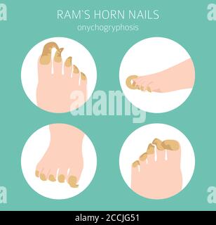 Nail diseases. Onychogryphosis, Ram`s horn nail. Medical infographic ...