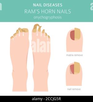 Nail diseases. Onychogryphosis, Ram`s horn nail. Medical infographic ...