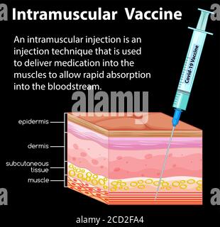 Information vector on intramuscular injection illustration Stock Vector ...