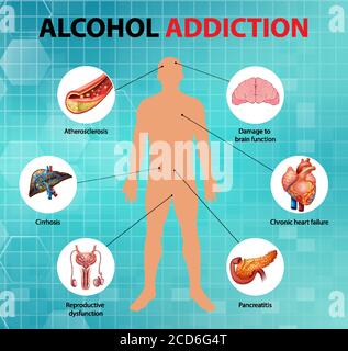 Alcohol addiction or alcoholism information infographic Stock Vector Image & Art - Alamy