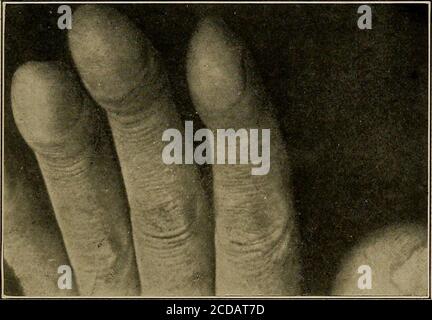 . Physical diagnosis . Fig. 52.—Clubbed Fingers.. Fig. 53.—Raynauds ...