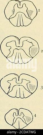Spinal cord, anterior side showing grey and white matter ...