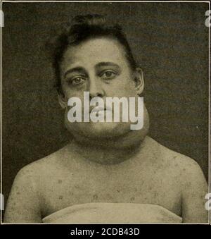 Syphilis. Syphilis disease blood test in doctor hand Stock Photo - Alamy