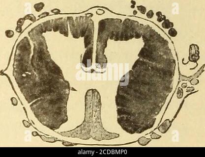 . Diseases of the nervous system . Fig. 101.—Tabetic Degeneration. cs ...