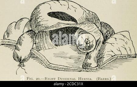 . On retro-peritoneal hernia . Fig, i6.—Left Duodenal Hernia, pushing ...