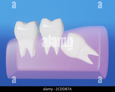 Impacted wisdom tooth, illustration Stock Photo - Alamy