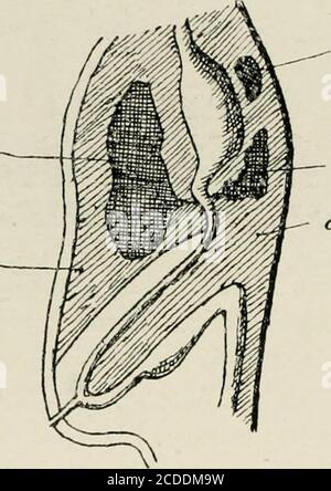 . On retro-peritoneal hernia . , with the first portion of the jejunum ...