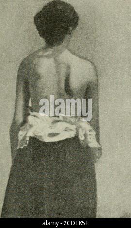 . Annals of surgery. Same as Fig. 7 (two months after operation).Dorsal ...