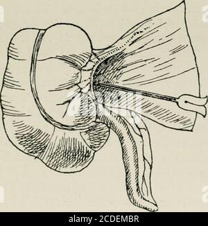 . On retro-peritoneal hernia . the ileo-colic artery is continued down ...