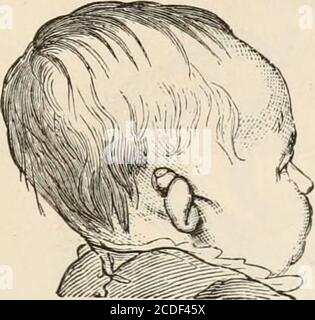 . The pathological anatomy of the ear . Fig. 13. Fig. 14 Stock Photo ...