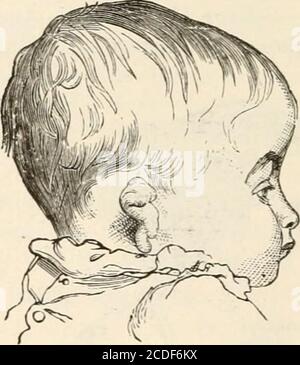 . The pathological anatomy of the ear . Fig. 13. Fig. 14 Stock Photo ...
