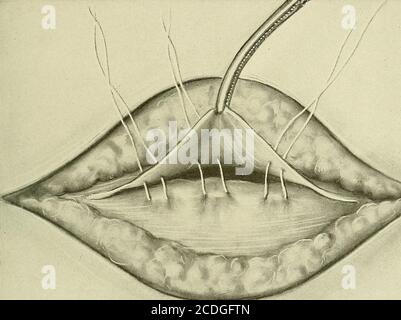 A wound umbilical hernia three days after the operation with plaster ...