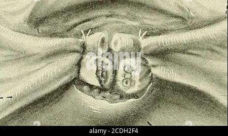 . Gynecology : . W.T!S, 3>Q>q(S Catccx Stumv> Fig. 381.—Supravaginal ...