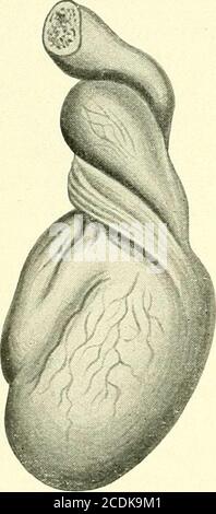 Inflammation of the testis Stock Photo - Alamy