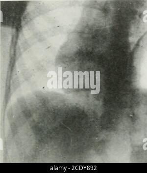 DIAPHRAGMATIC HERNIA, X-RAY Stock Photo - Alamy