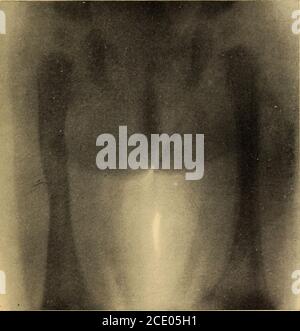 Smith fracture, X-ray Stock Photo - Alamy