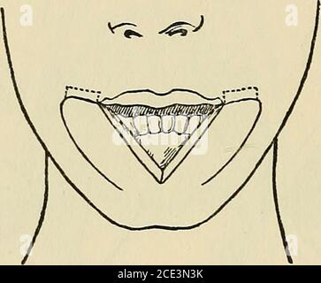 . Operative surgery, for students and practitioners . and this is to be ...
