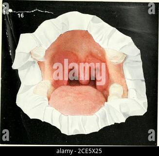 Swollen Soft Palate And Uvula: Uvula Inflammation Treatment – EICQN