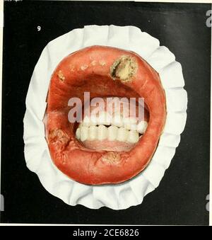 Syphilis ulcer on lower lip Stock Photo - Alamy