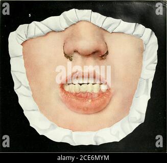 Syphilis ulcer in mouth Stock Photo - Alamy