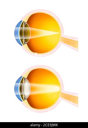 Medical illustration of a cataract in the human eye, compared to a ...