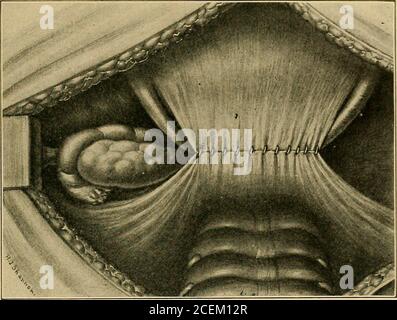 . Pelvic inflammation in women. Fig. II.—Incision Circling the Limits ...