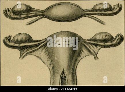 . Pelvic inflammation in women. Fig. 79.—The Cervix is then Drawn up ...