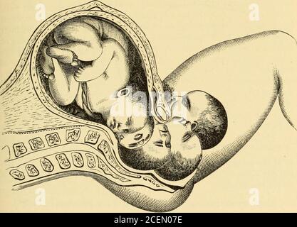 Mechanism of mento-anterior positions in childbirth. Lithograph after W ...