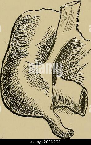 . On retro-peritoneal hernia . the ileo-colic artery is continued down ...