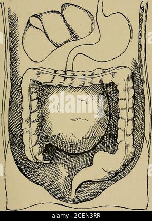On retro-peritoneal hernia . the abdominal cavity a sac containing ...