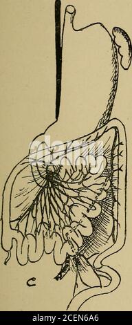 . On retro-peritoneal hernia . , with the first portion of the jejunum ...