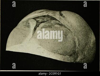 . The diseases of infancy and childhood. Deformity of the Chest in ...